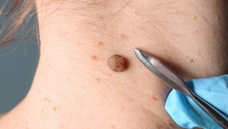 Nei maligni, il primo sintomo è anche quello più importante: conoscerlo ...