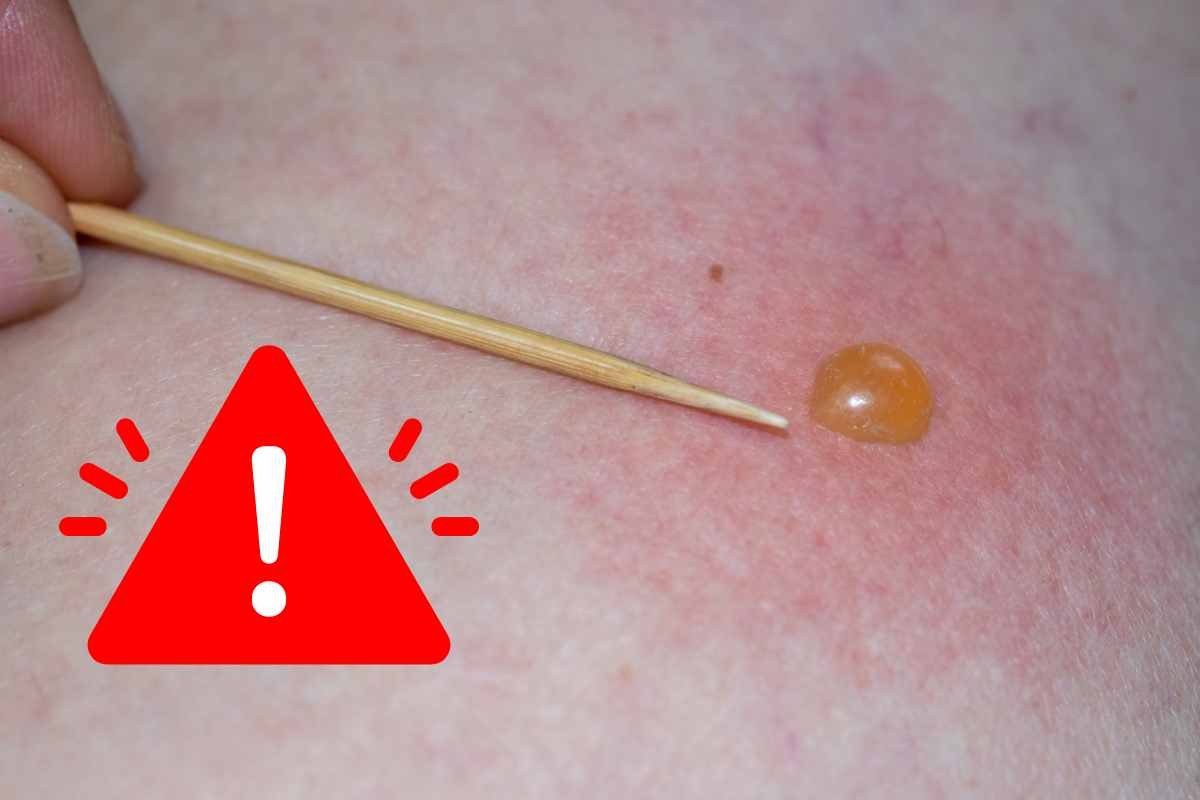 Dita amputate per il morso di questo ragno estivo: attenzione, come ...